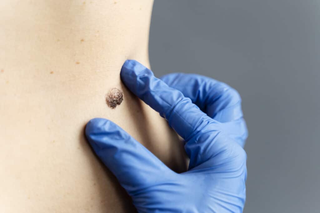 Why Skin and Mole Checks Are Essential for Early Skin Cancer Detection