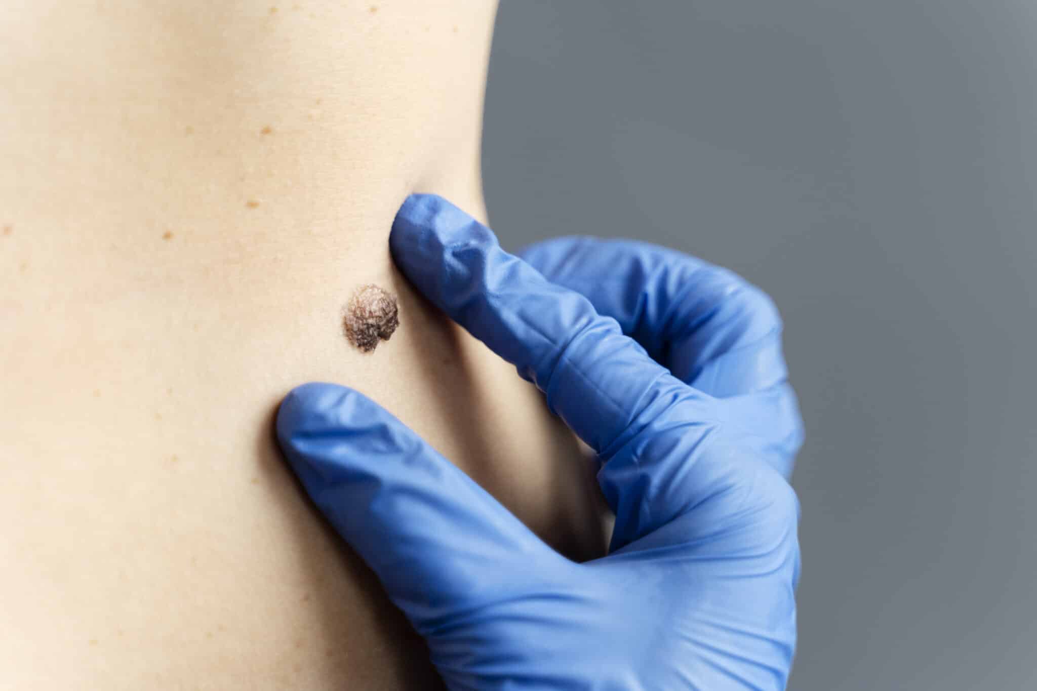 Why Skin and Mole Checks Are Essential for Early Skin Cancer Detection